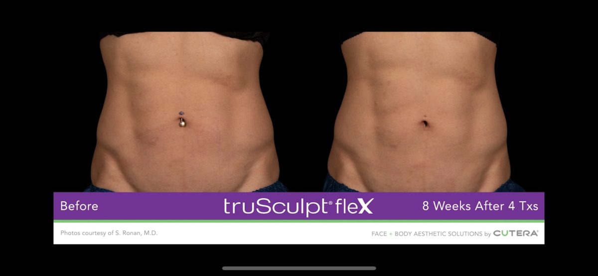Trusculpt Flex Body Contouring Treatment Mirabile Md In Overland Park