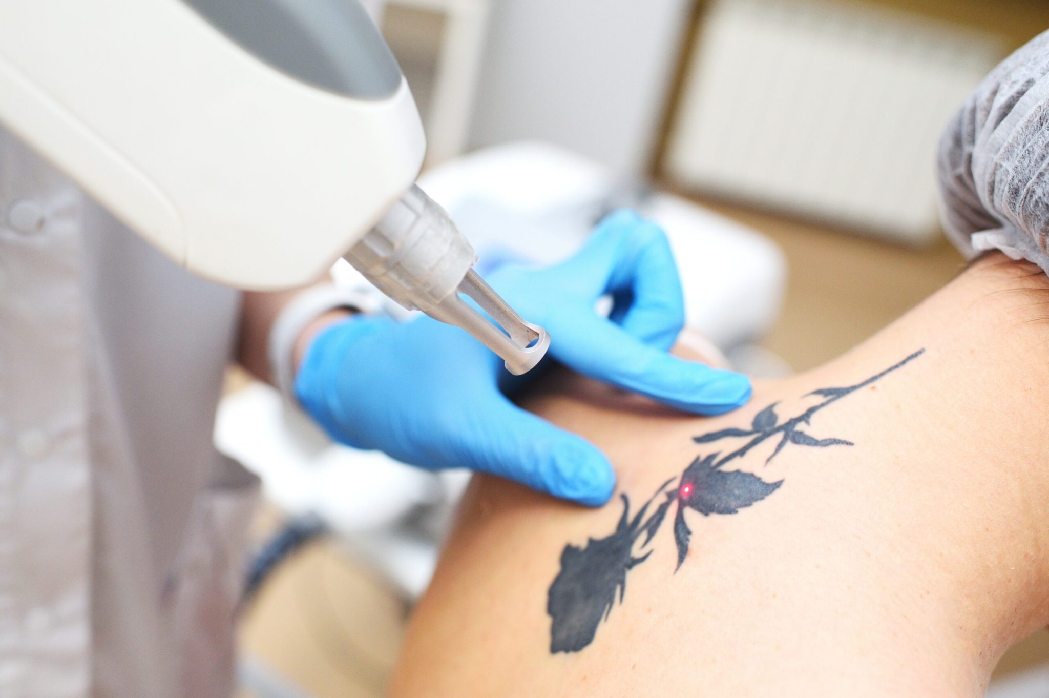 Tattoo & Microblading Removal: Full Guide